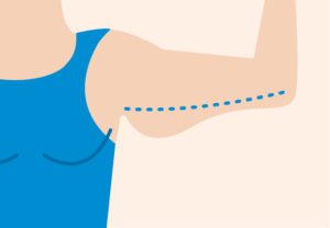 How to Fight Excess Skin After Your Bariatric Surgery? | McCarty Dallas